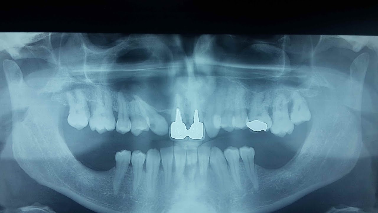 MASSIVE CYSTS MAXILLARY......WARNING - YouTube