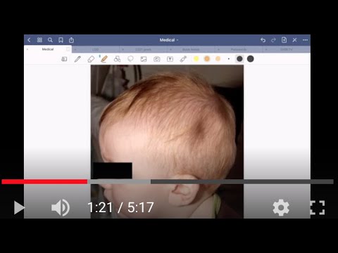 Clinical Case: child bumps head and now has a ‘dent’ in his skull - YouTube