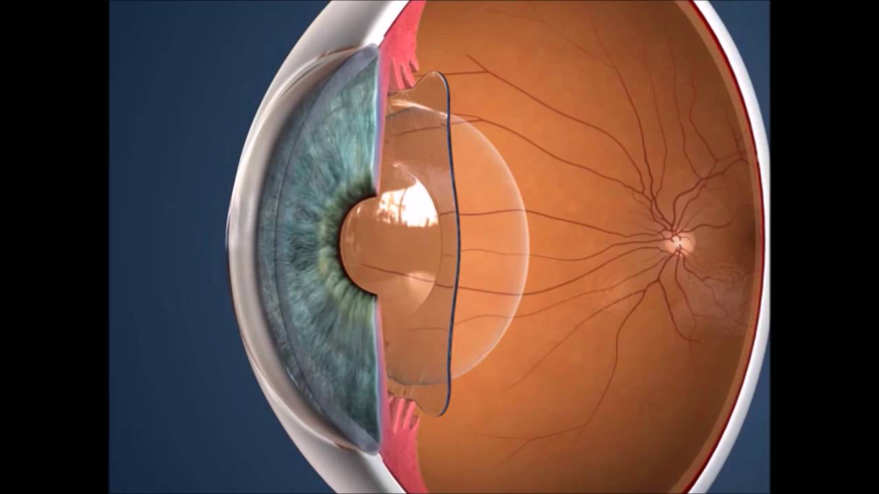 icl 수술과정 - YouTube