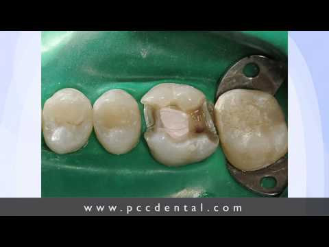 Endo Crown Down Technique