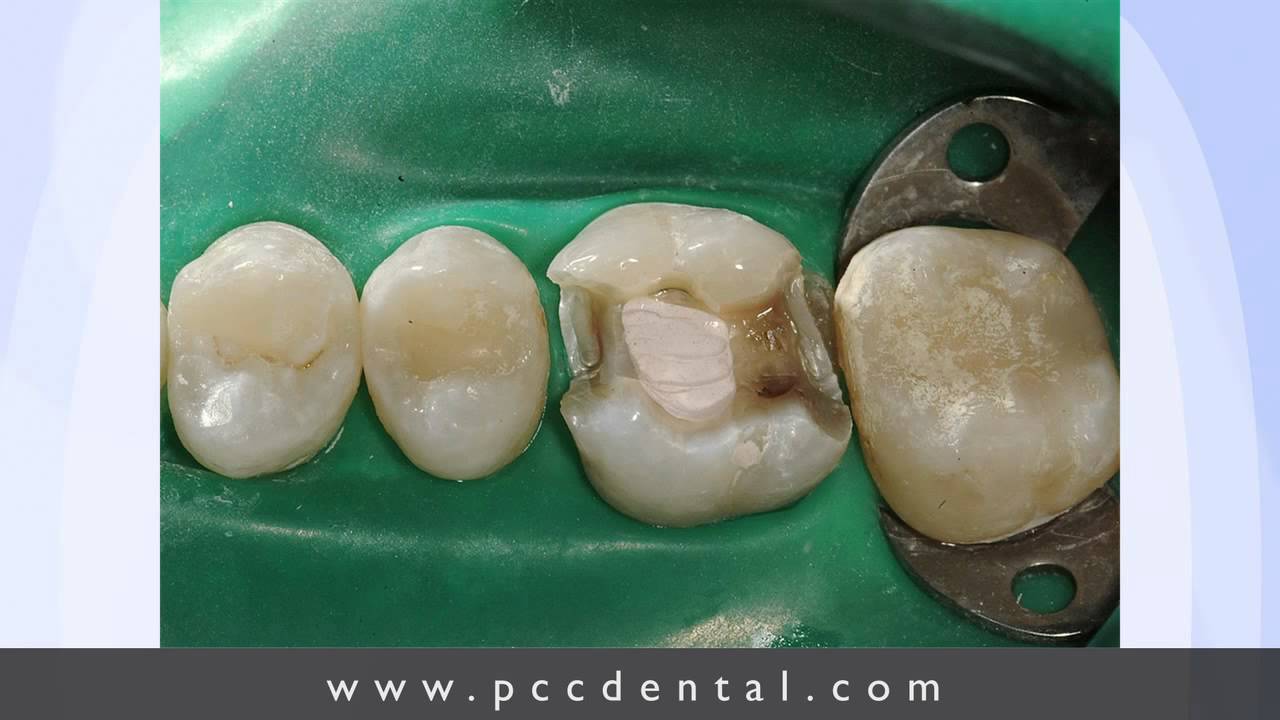 Ask Gordon: Crown-down endo and need for posts - YouTube