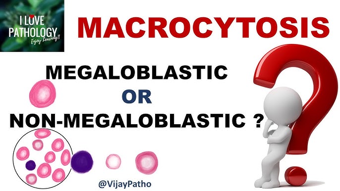 Avoid Macrocytic Anemia ICD 10 Code Error: The Ultimate, 59% OFF Avoid Macrocytic Anemia ICD 10 Code Error: The Ultimate, 59% OFF