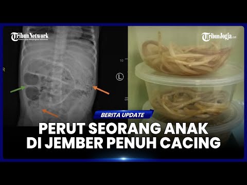 PERUT SEORANG ANAK DI JEMBER PENUH CACING HINGGA SULIT BAB