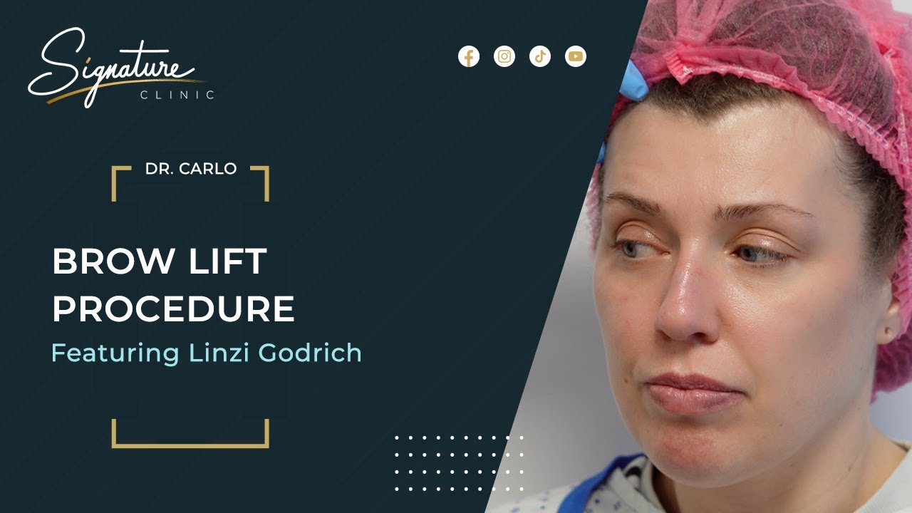 Brow Lift - Patient Journey - Signature Clinic - YouTube