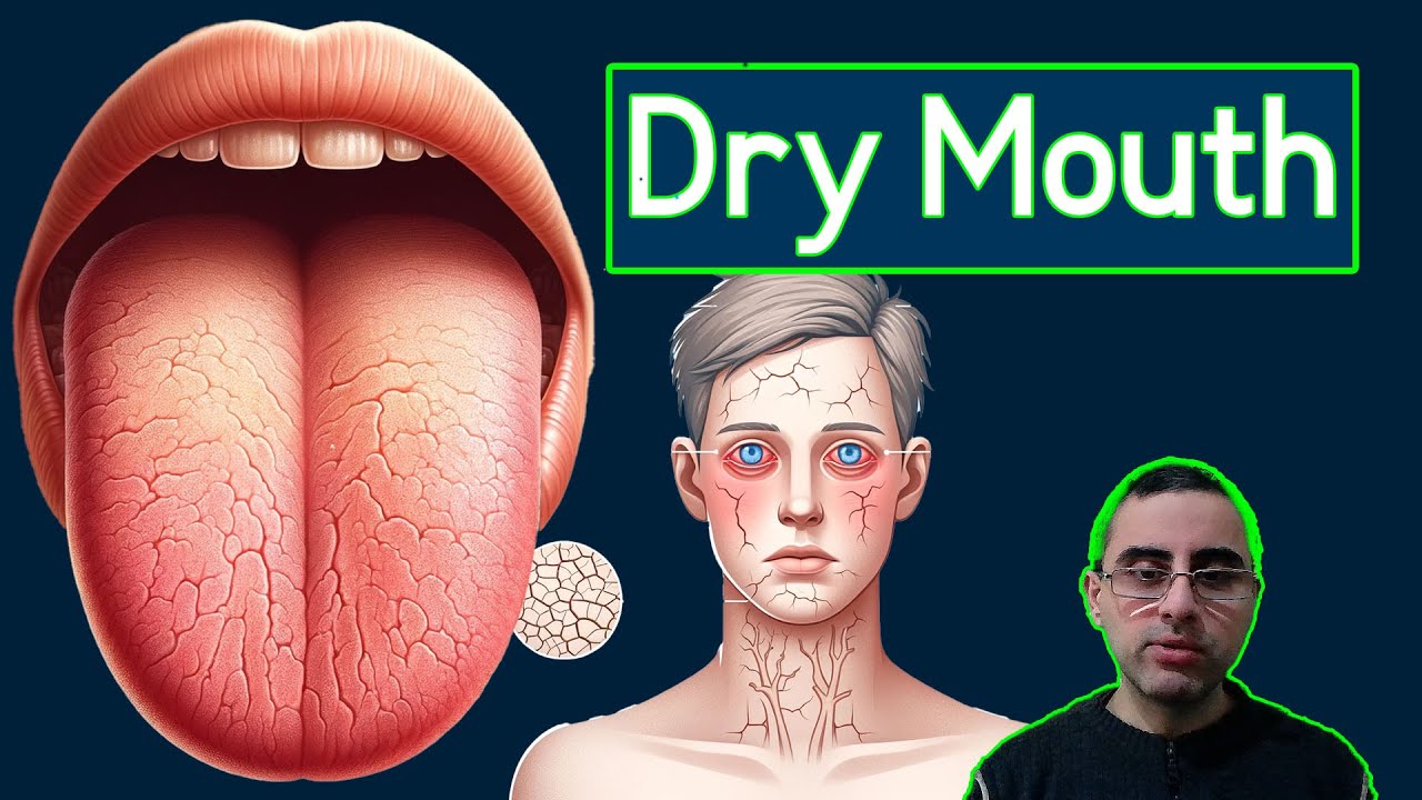 Top 7 Causes of Dry Mouth (Xerostomia) and Treatment - YouTube