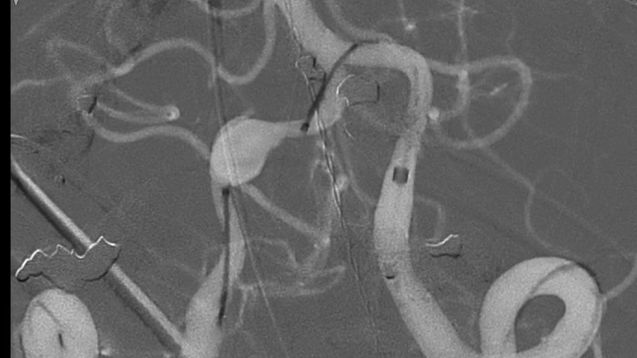 WEB device for vertebral dissection aneurysm and V4 occlusion - YouTube