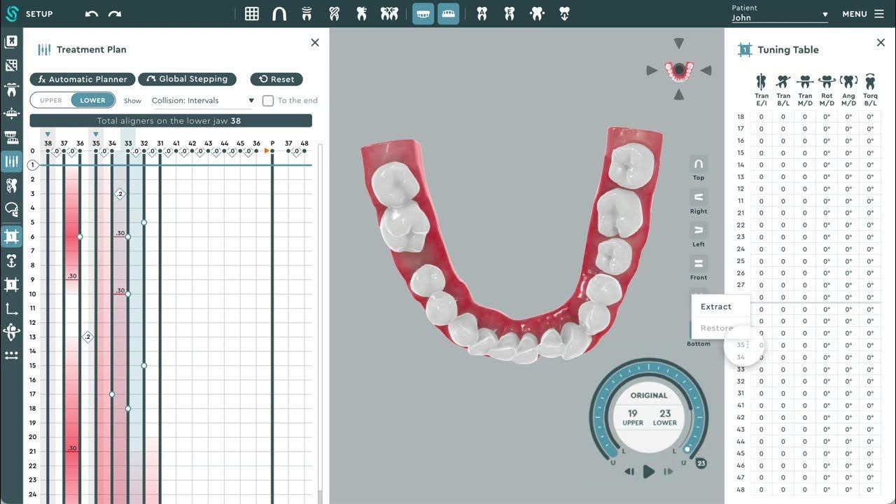 Extract/Restore Tool for Aligner Treatment Planning Software - YouTube