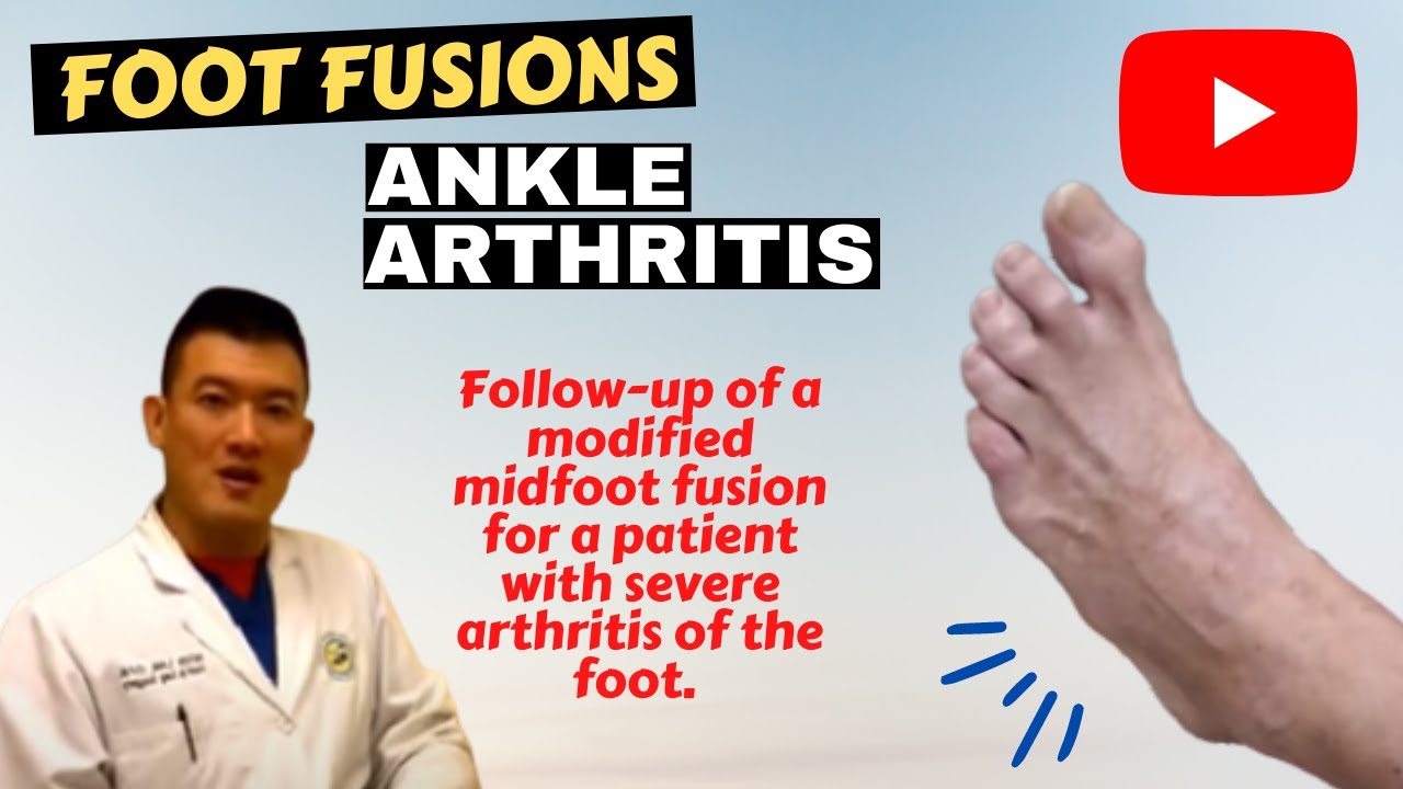 Dr. Kevin Lam: Follow-Up on Modified Midfoot Fusion for Severe ...