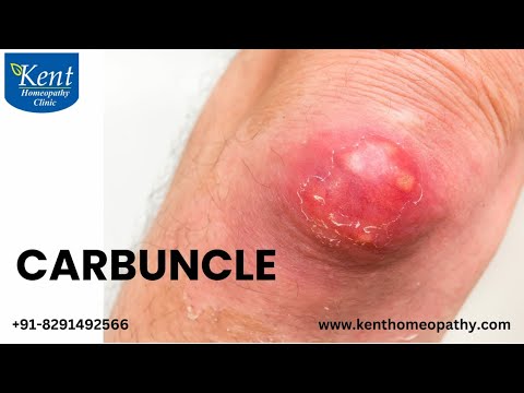 Carbuncle-homeopathy treatment #drkukrejakalani #kenthomeopathyclinic # ...