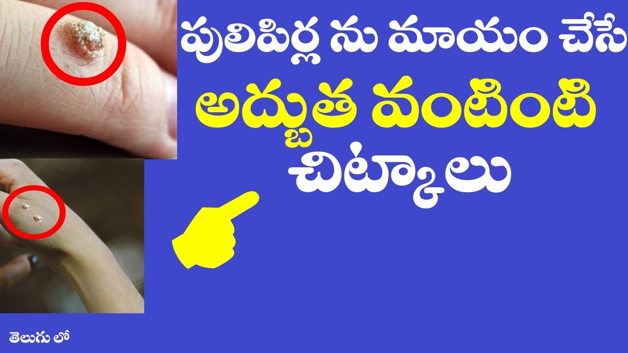 పులిపిర్లను మాయం చేసే అద్బుత వంటింటి చిట్కాలు || #Warts || #Pulipirlu ...