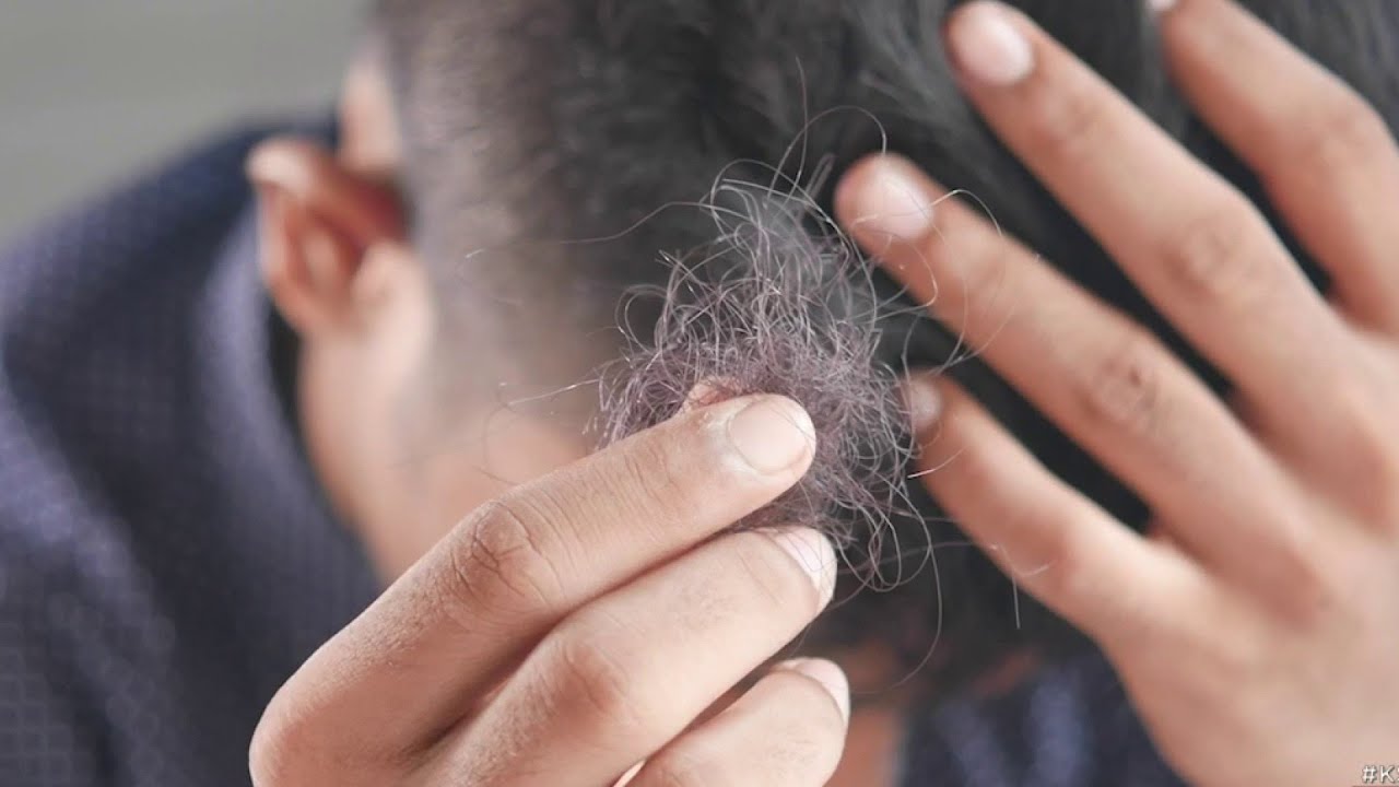 Lacking locks? What's causing your hair to fall out? - YouTube