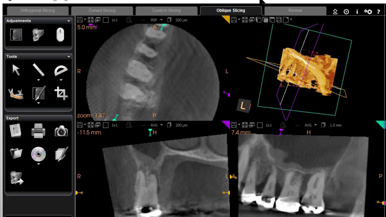 Cracked Tooth Detection Cbct Youtube