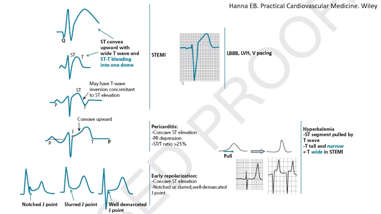 ST elevation on ECG, part 1: Differential diagnosis and case studies ...