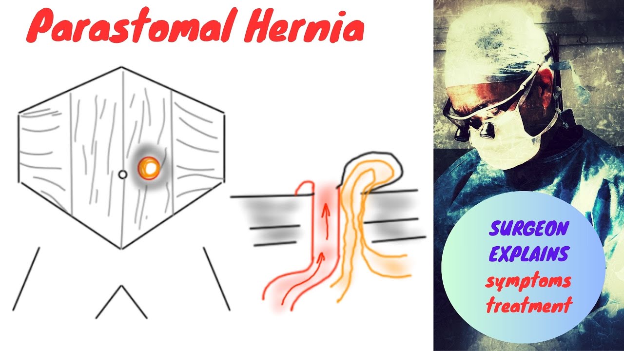 Parastomal Hernia Symptoms and Treatment - YouTube
