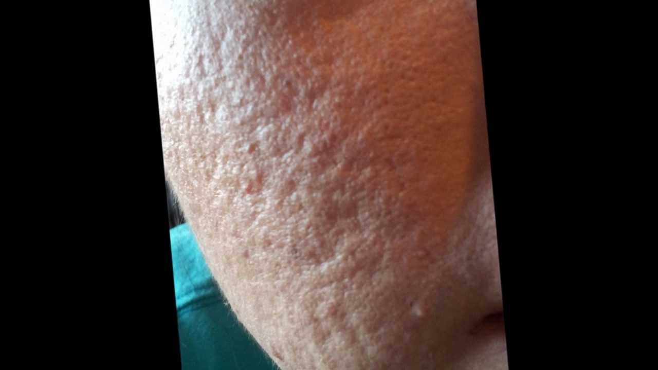 My TERRIBLE Acne Scars - YouTube