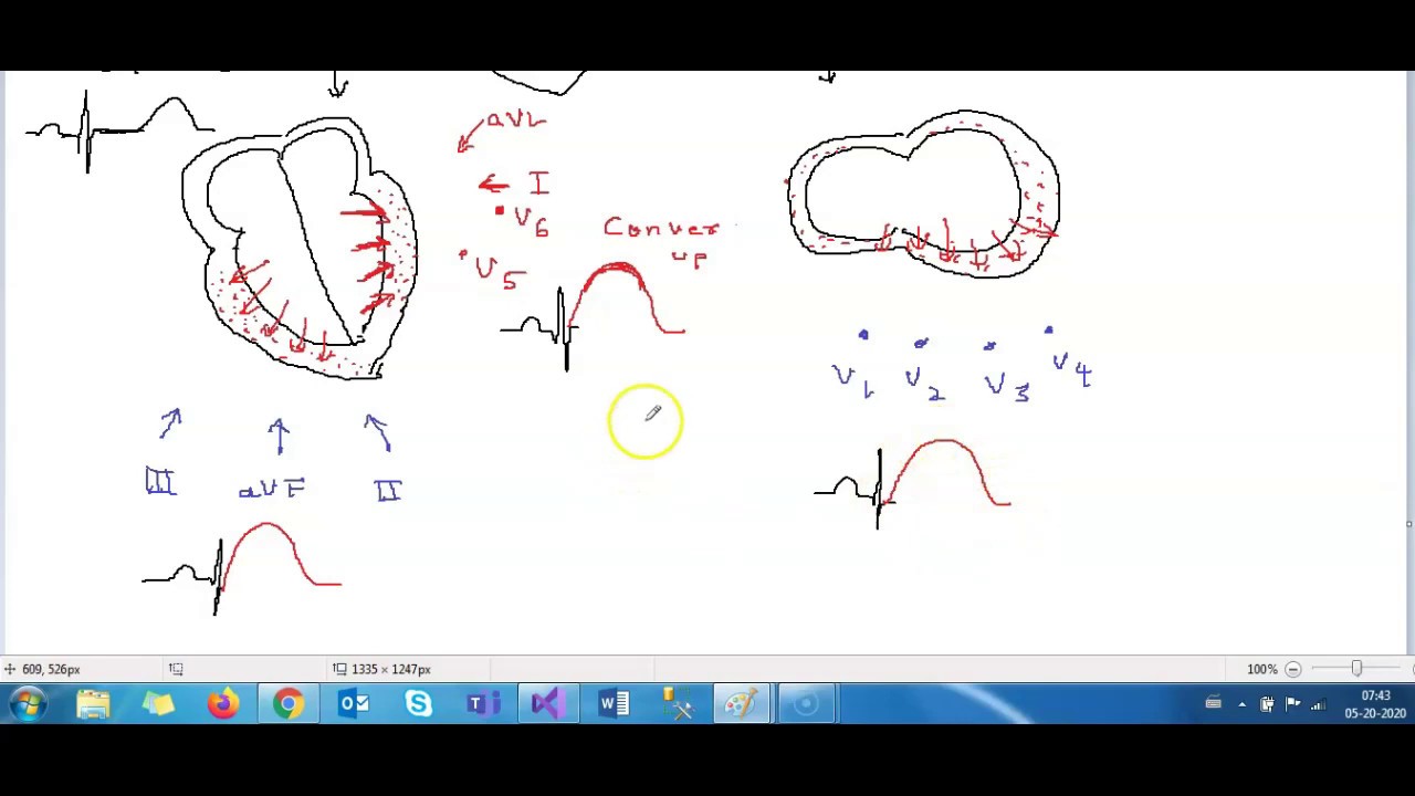 Myocarditis- Presentation - YouTube