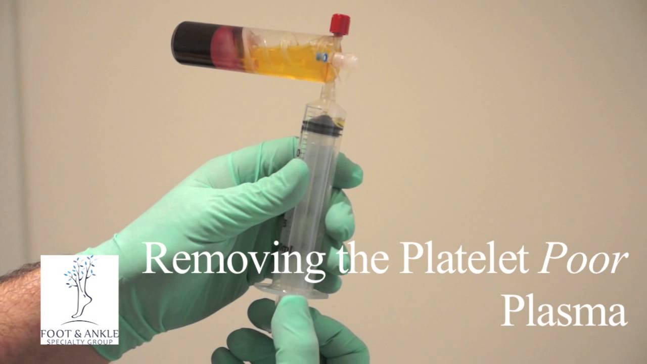 PRP Platelet Rich Plasma Therapy for Chronic Tendinosis, Ankle Pain ...