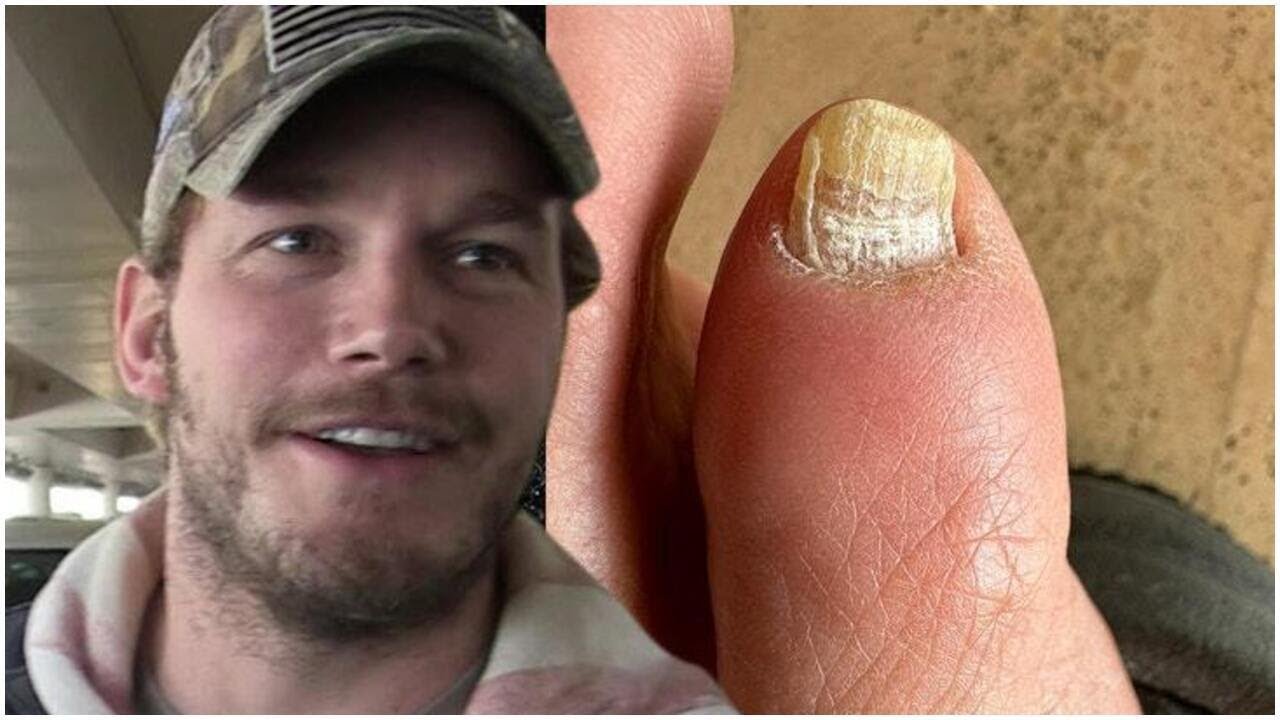 Chris Pratt Diagnosed With Toe Fungus by 'My Feet Are Killing Me ...