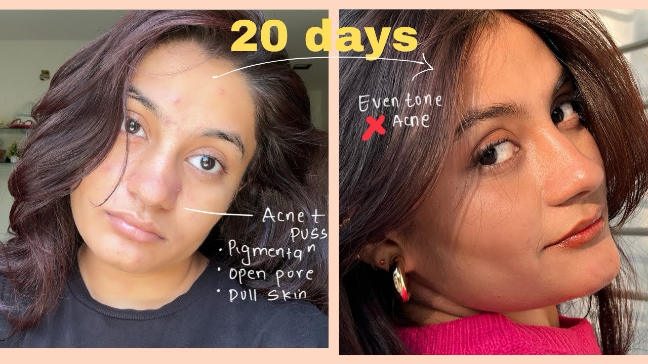 Skin Barrier Building ( rejuvenating OILY ANCE prone skin) inexpensive ...
