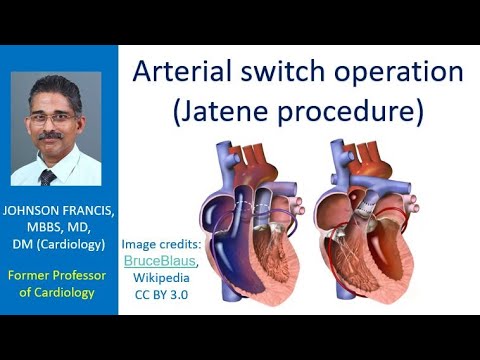 Arterial switch operation (Jatene procedure) - YouTube