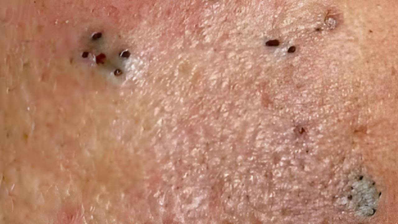 Big Cystic Acne Blackhead, Extraction Blackheads & Milia #237 ...
