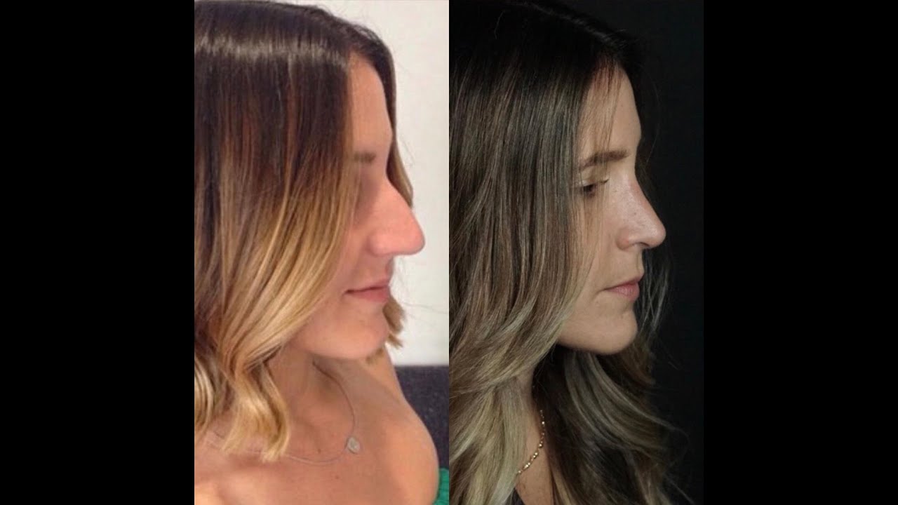MODEL AFTER SCARLESS NOSE JOB - RHINOPLASTY SURGERY!! - YouTube