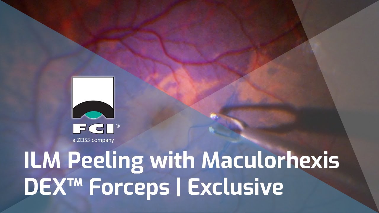 ILM Peeling with Maculorhexis DEX™ Forceps | Exclusive - YouTube