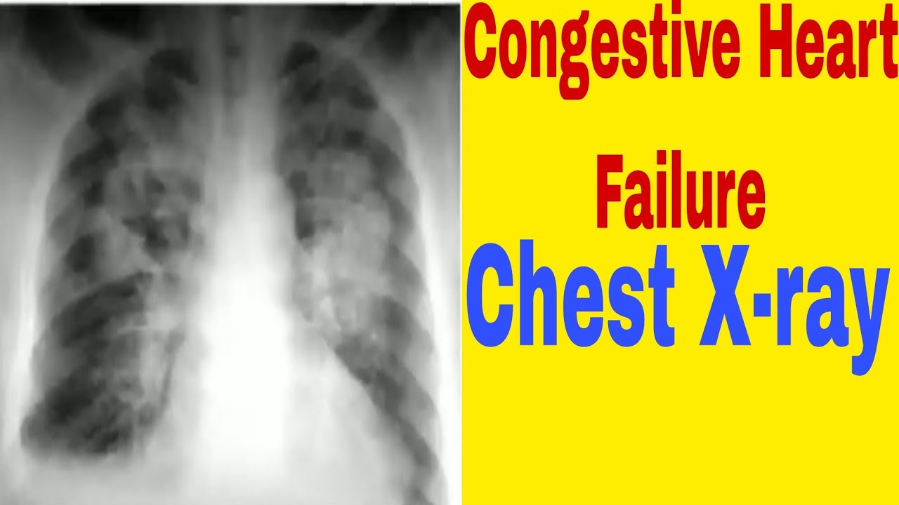 Congestive Heart Failure. CHF.Congestive Heart Failure developed ...