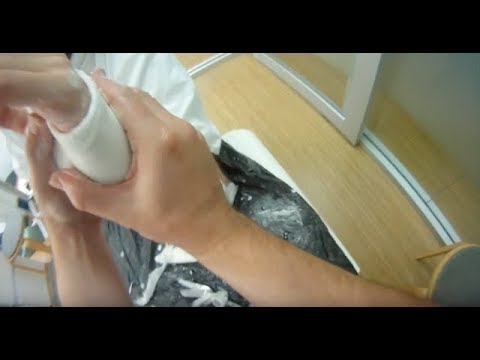 Plaster Cast Application For Broken Wrist POV - YouTube