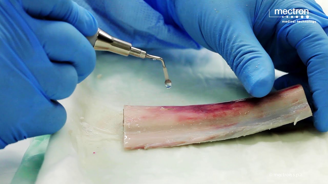 Surgical insert tips instructions - NOT TO DO - YouTube