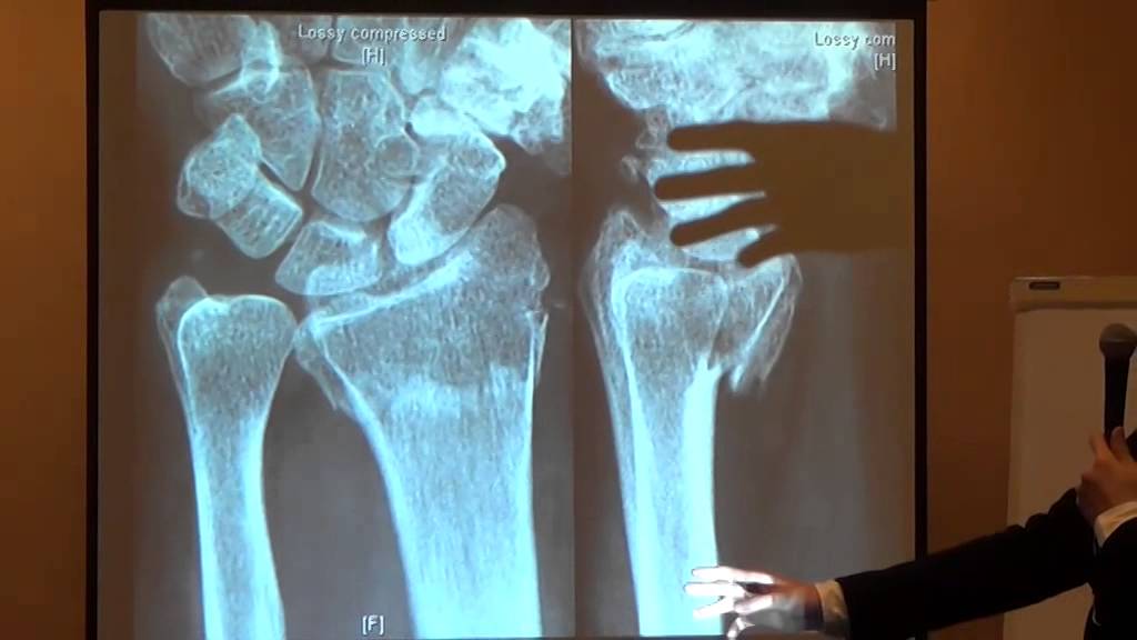 Distal radius cases - dr. Aaron Gan's techniques - YouTube