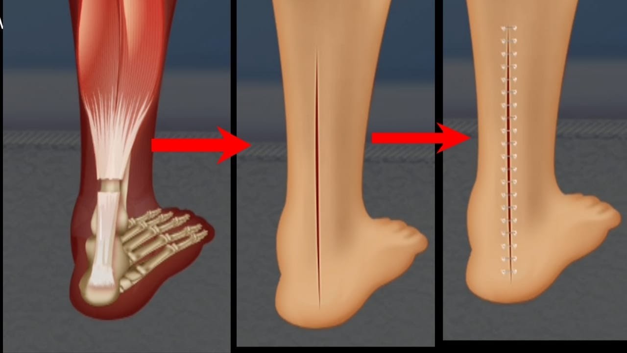 foot tendon repair - YouTube
