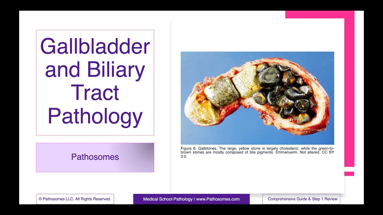 Gallbladder Pathology and Biliary Tract Pathology | Comprehensive Guide ...