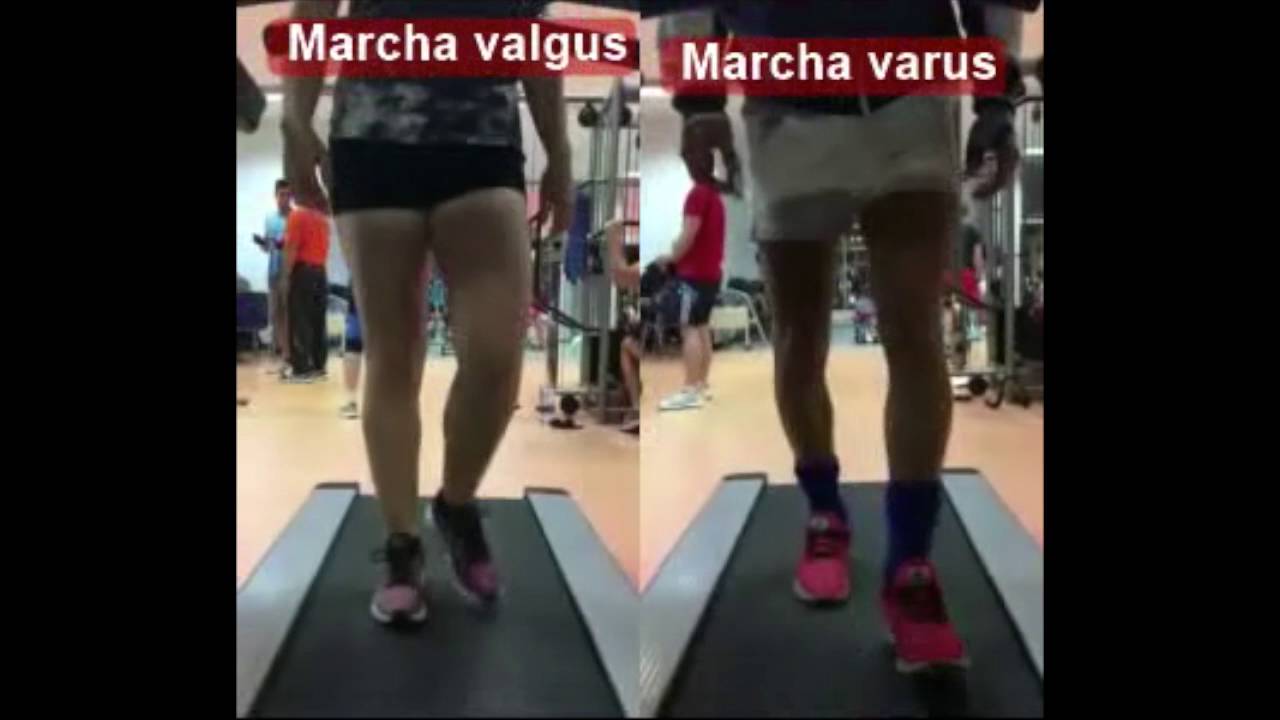 Analisis de la Marcha : Varo vs Valgo - YouTube