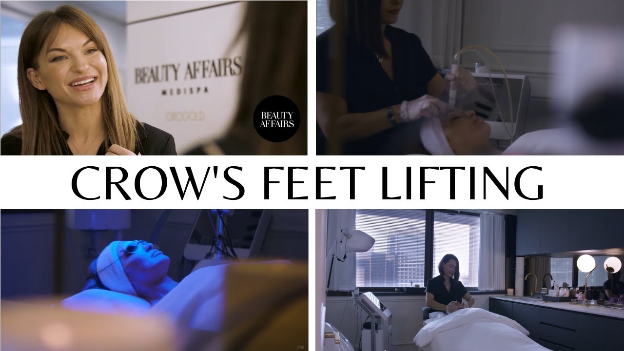 Skin Care: Beauty Affairs Crows Feet Lifting - YouTube