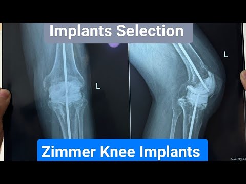 Zimmer Knee Implants selection #cck #rhk #nexgen Hindi/urdu - YouTube
