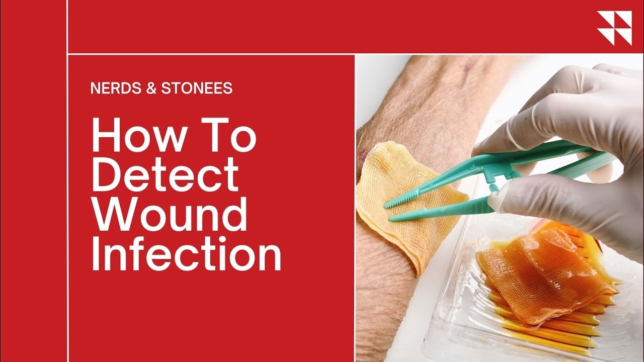 NERDS & STONEES: A Guide to Detecting Wound Infection - YouTube