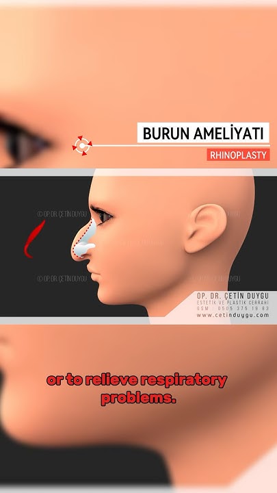 BURUN AMELİYATI ANİMASYON! - YouTube