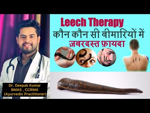 Leech therapy for pimples | leech therapy benefit | @DrDeepakKumar104 - YouTube