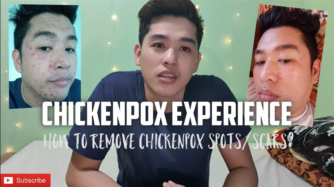 Chickenpox Experience | How to Remove chickenpox spots/scars? - YouTube