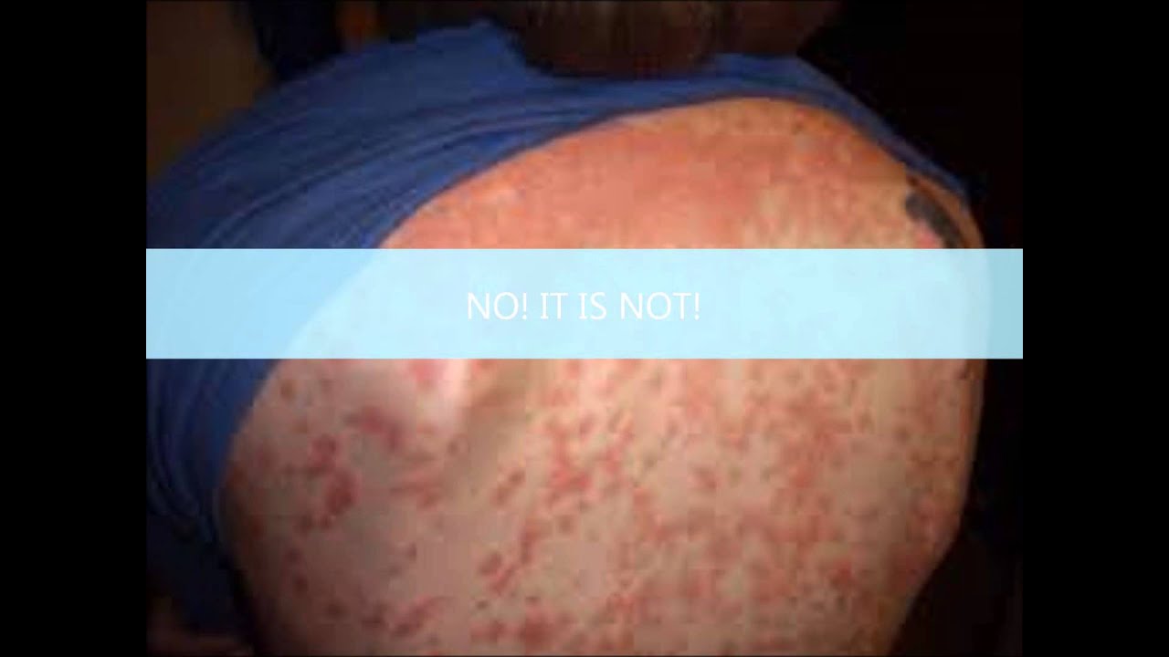 Is Psoriasis Contagious? Watch This To Find Out! - YouTube