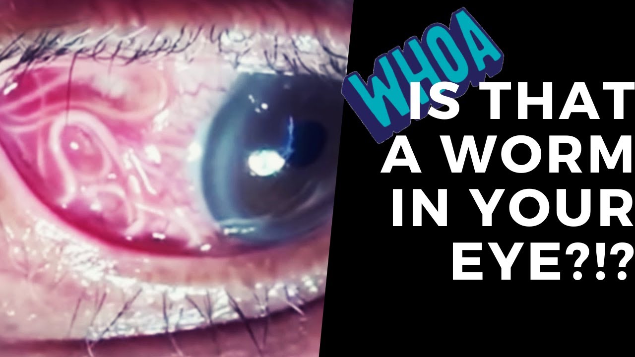 IS THAT A WORM IN YOUR EYE?!? - YouTube