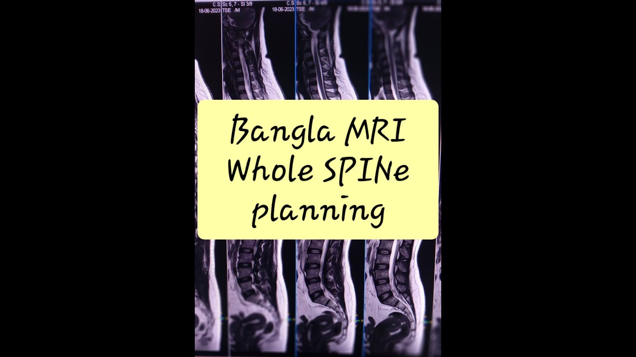 BANGLA MRI WHOLE SPINE PLANNING PHILIPS 3T.#mri#philips - YouTube