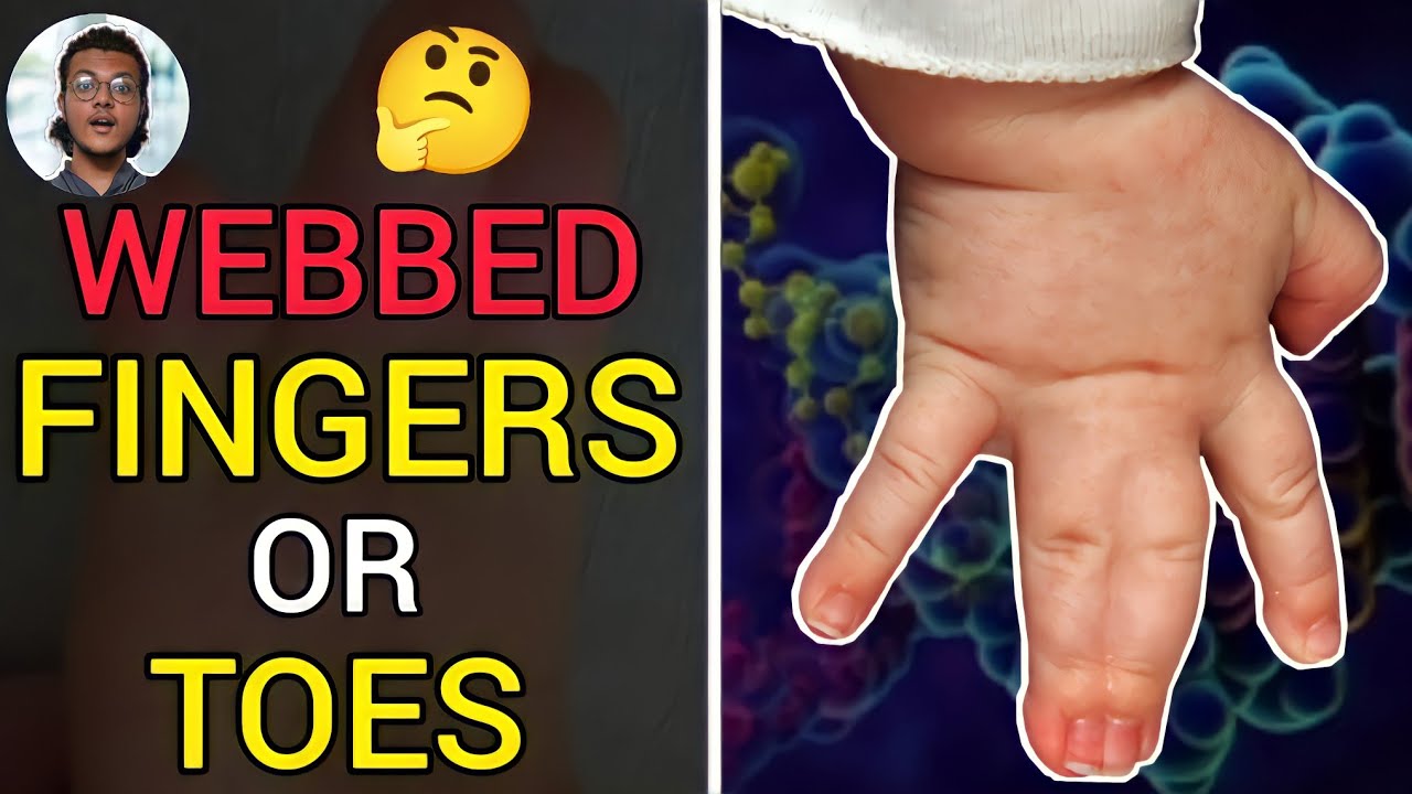 Syndactyly | Webbed fingers or toes | Harsh Mukhbir || #shorts - YouTube