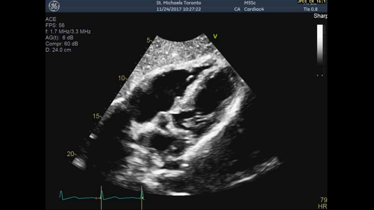 External left atrium compression by spinal osteophytes: 1/2 - YouTube