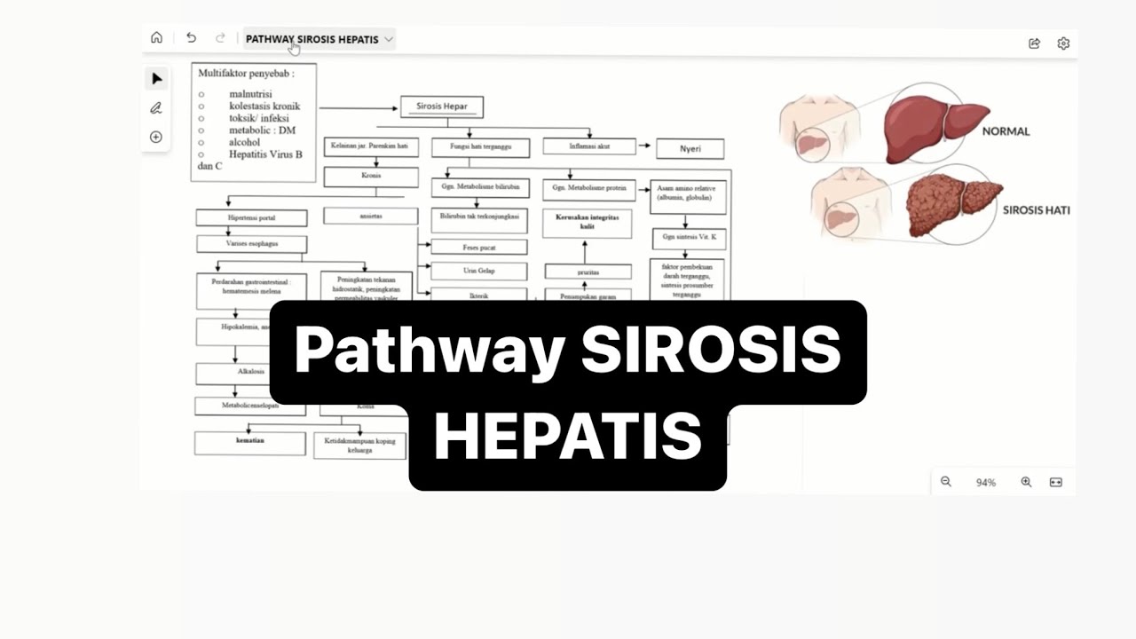 Pathway SIROSIS HEPATIS | DIAGNOSA KEPERAWATAN eps.13 - YouTube