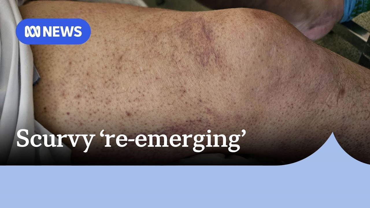 Perth man diagnosed with scurvy, a disease doctors 'thought we had ...