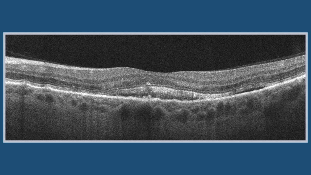 1 Retinal Pigment Epithelium (RPE) - YouTube