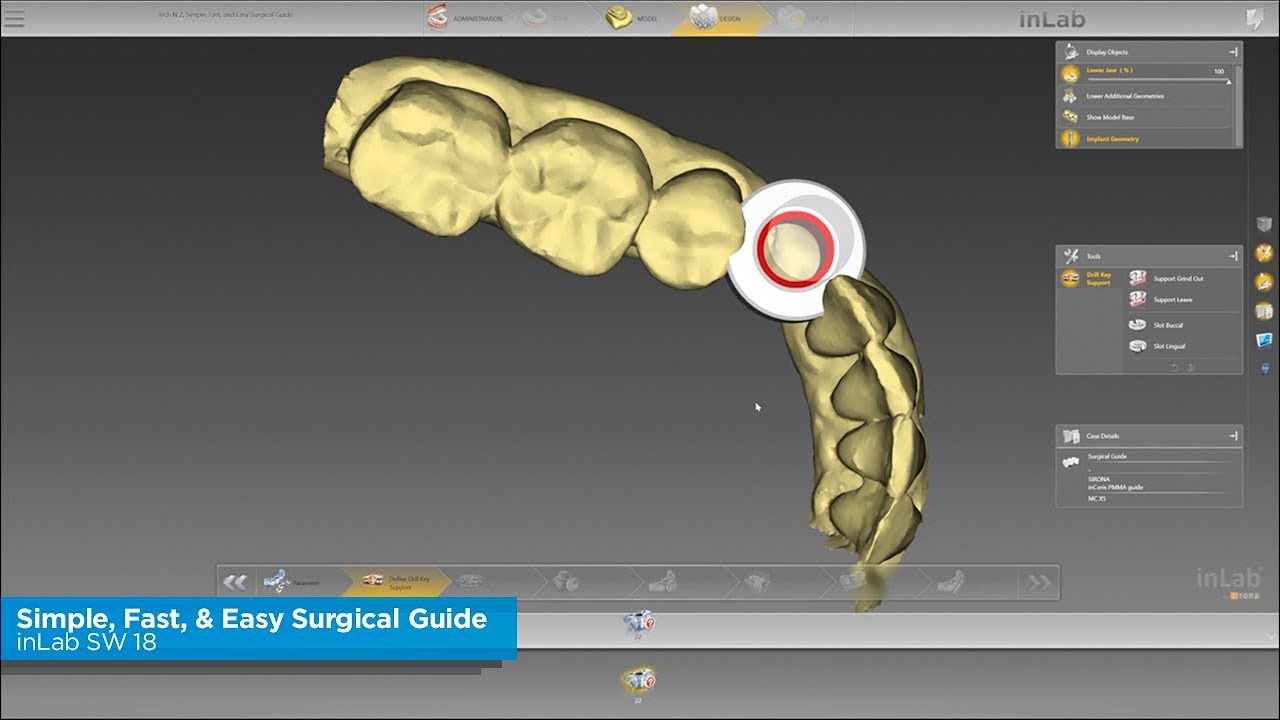 inLab SW 18: Simple, Fast, & Easy Surgical Guide - YouTube