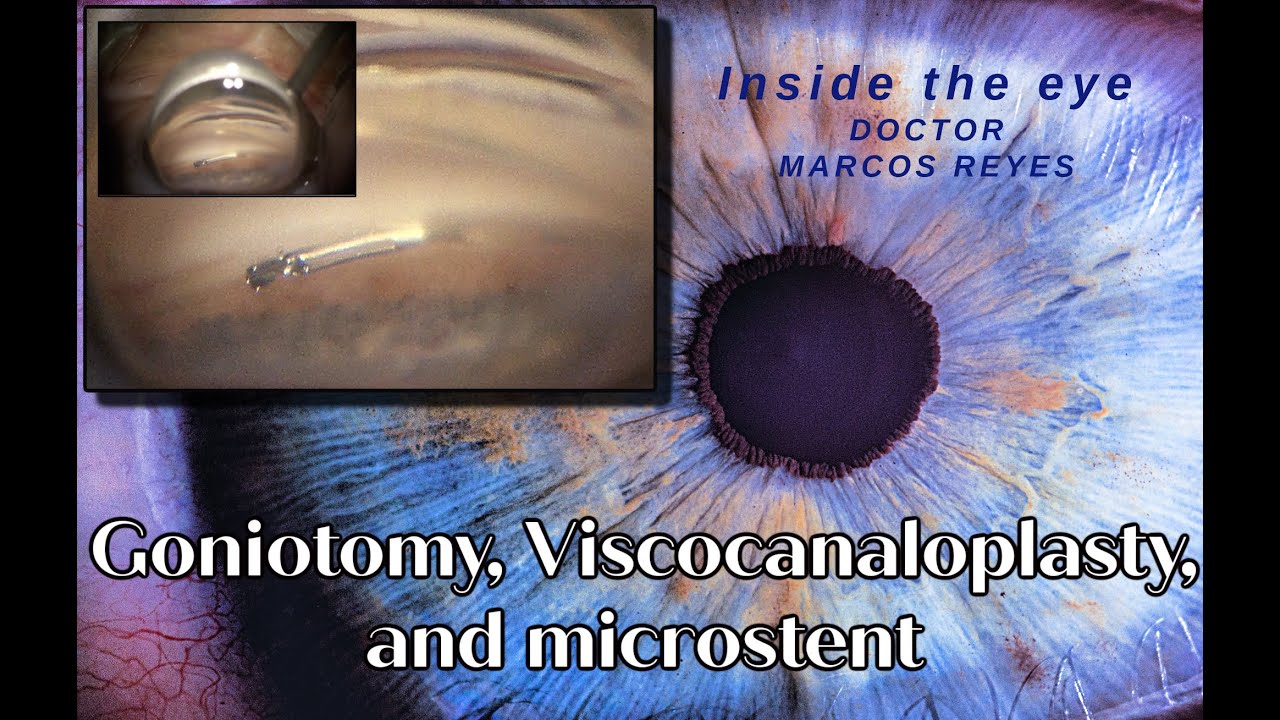 Goniotomy, Viscocanaloplasty, Microstent - YouTube